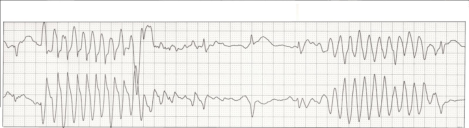 EKG Rhythm Strips 12- ventricular rhythms
