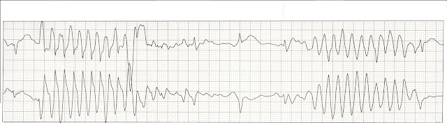 EKG Rhythm Strips 12- ventricular rhythms