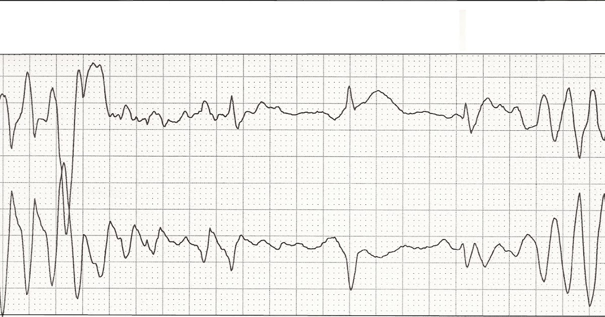 EKG Rhythm Strips 12- ventricular rhythms