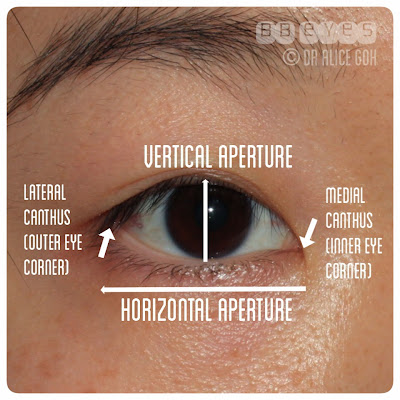 Dr. Alice Goh: Doctor, Can you make my eyelids longer?