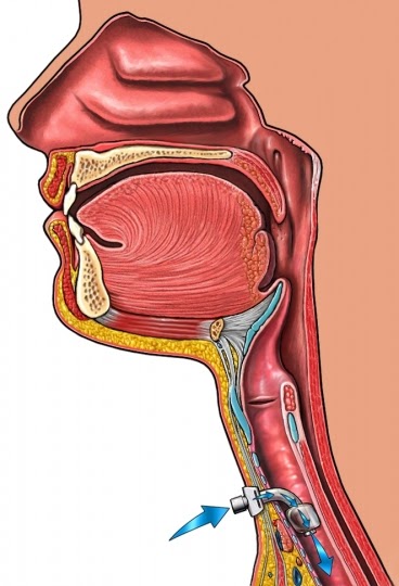 Respiratory Therapy Cave: What is a tracheostomy?