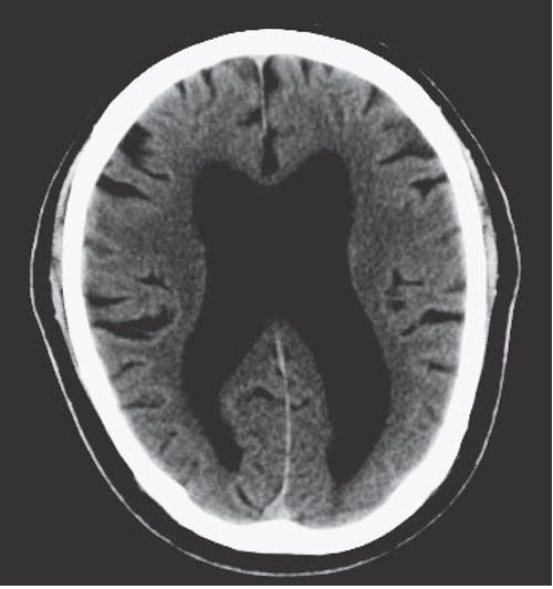 Study Medical Photos: Differential Diagnosis Of Normal Pressure ...