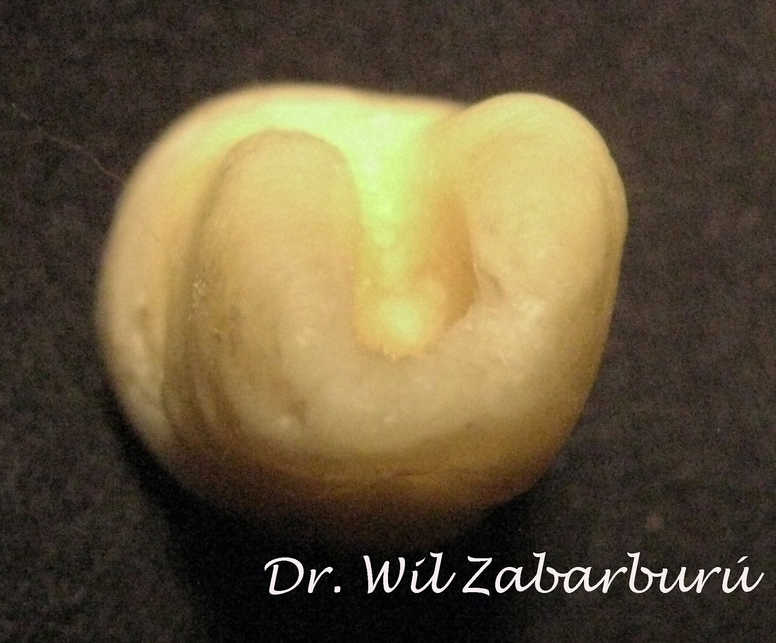 CLINICA DENTAL ASISTENCIAL: The C-shaped molar