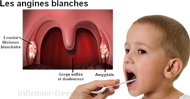 Les angines blanches ~ Santé et les soins infirmiers