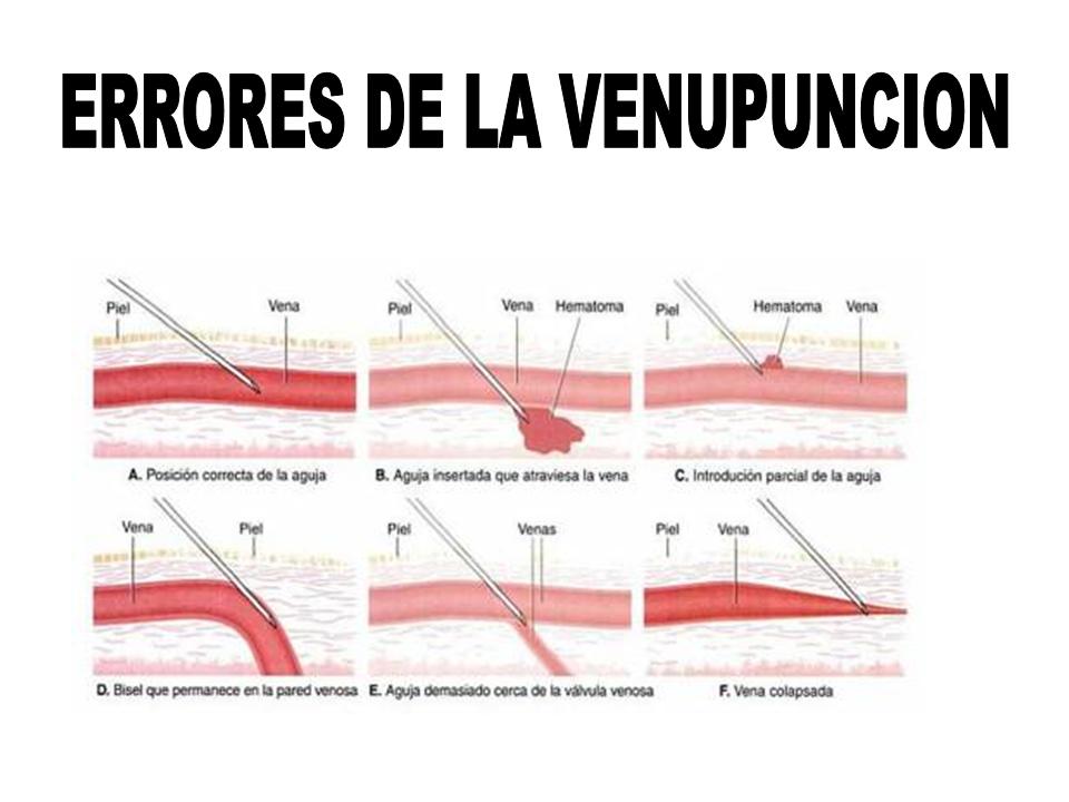 CONOCIMIENTOS BÁSICOS - NURSING: VENOCLISIS - CATETERISMO PERIFÉRICA