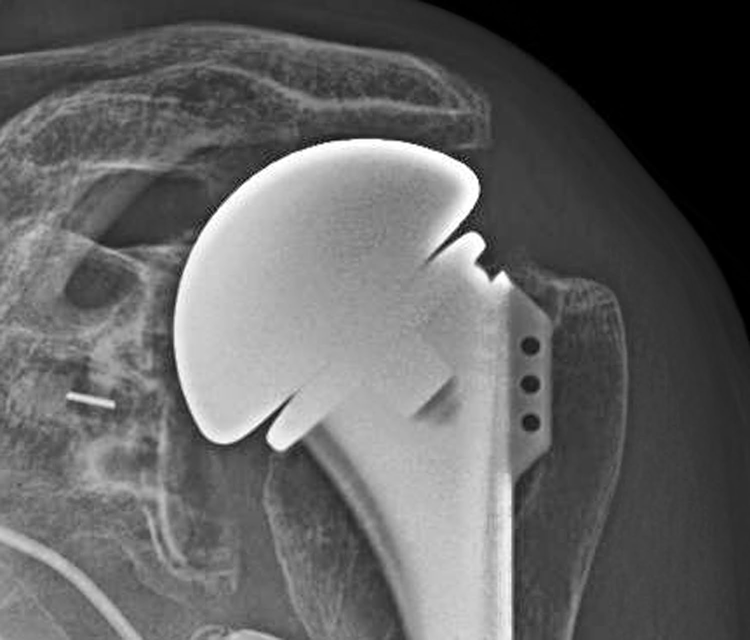 UW Shoulder and Elbow Academy: Failure of anatomic total shoulder joint ...