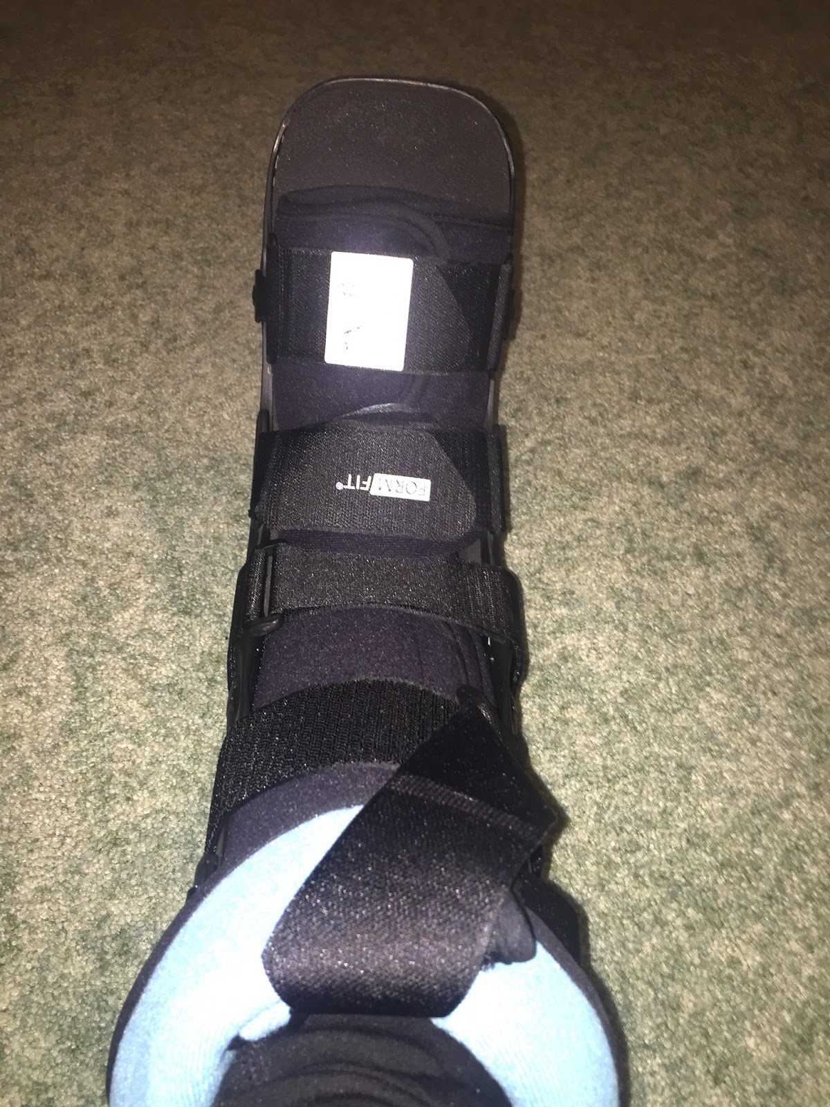 Before, During, & After Bunion Surgery...: First Two Weeks after ...