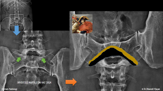 Ultimate Radiology : Inverted Napoleon Hat Sign