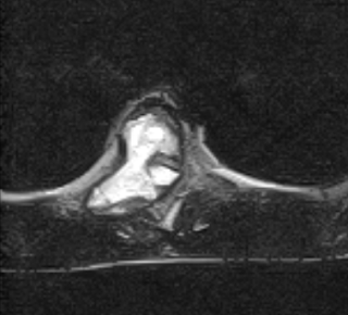 Aneurysmal bone cyst- MRI - Sumer's Radiology Blog