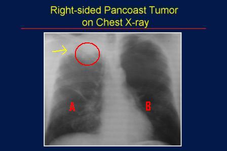 Pancoast Tumor in circle