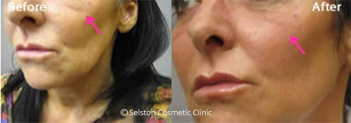 Selston Cosmetic Clinic: Restore Volume in Sunken Hollow Cheeks using ...