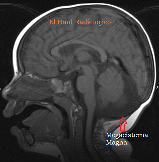 El Baúl Radiológico: ASPECTO DE LA CISTERNA MAGNA EN TOMOGRAFÍA ...