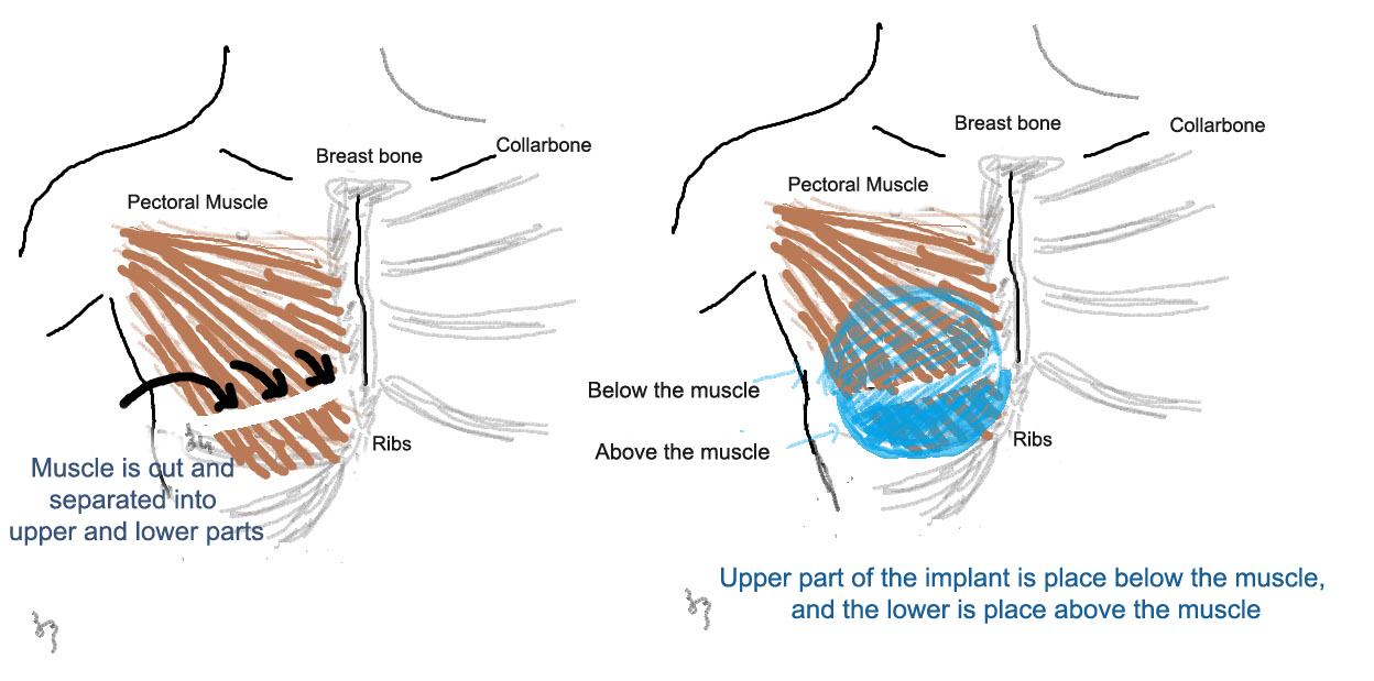 Dr. Lee Breast augmentation Korea: Breast augmentation Korea - about ...