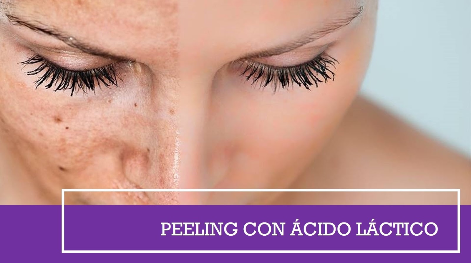 Coco Montesinos: PEELING CON ÁCIDO LÁCTICO