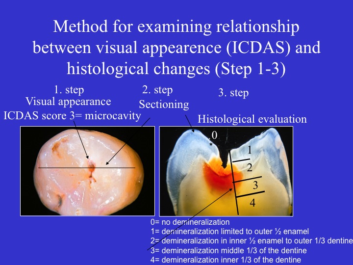 ICDAS-JHCDA: ICDASのHPが更新されました