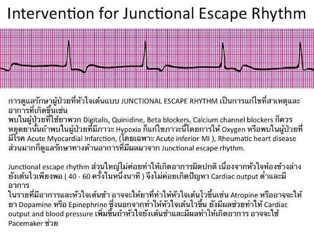 JUNCTIONAL ESCAPE RHYTHM