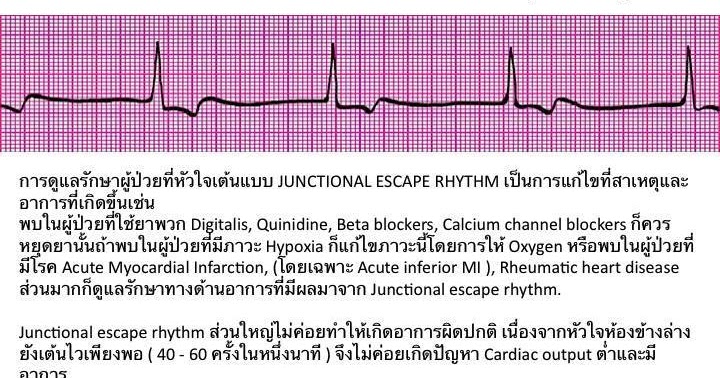 JUNCTIONAL ESCAPE RHYTHM
