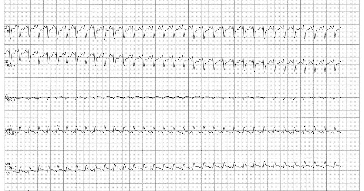 Supraventricular Tachycardia