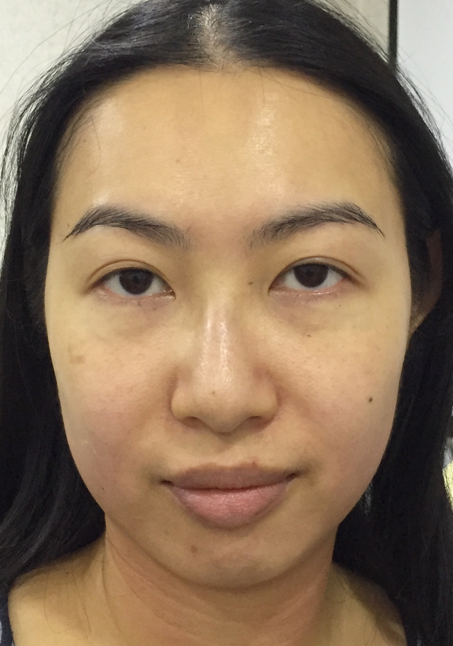 Wintyb 的瘋狂生活: Viora Reaction CORE 提升面型輪廓療程