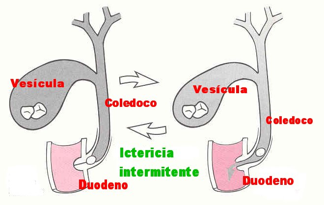 Coledocolitíase , ou