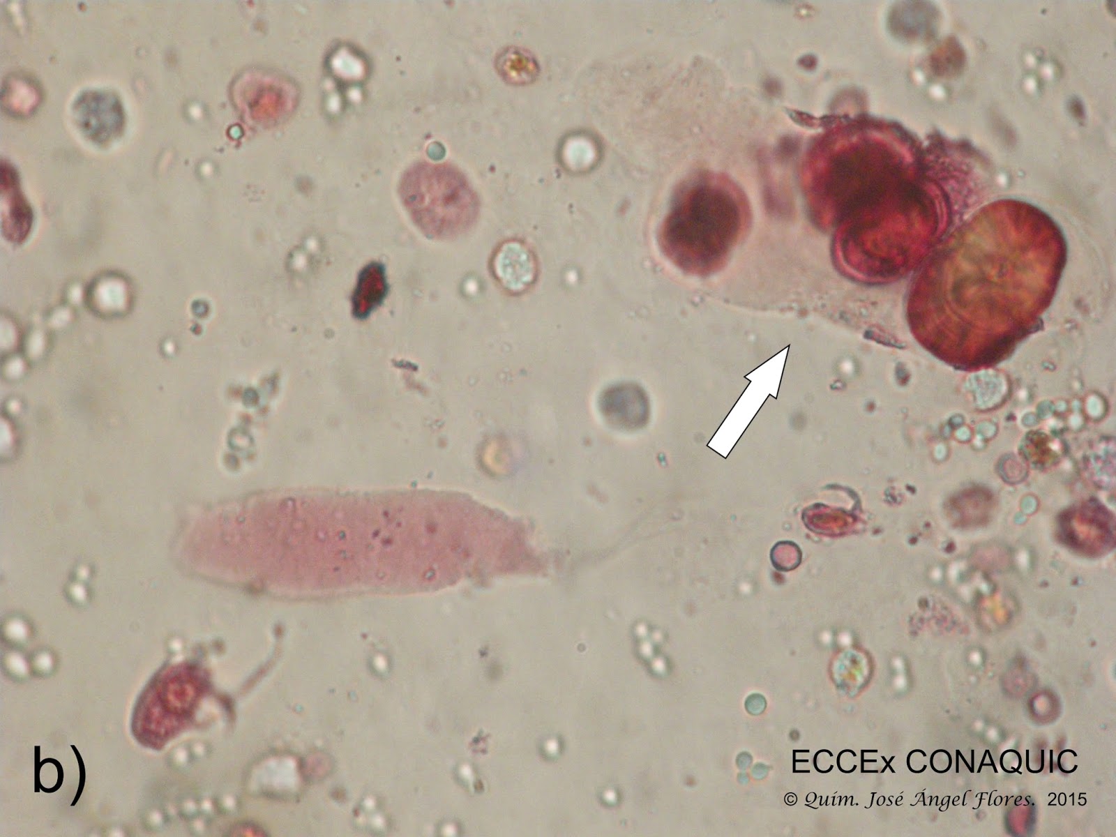 Caso UR-julio-15 (Enfoque: Cilindruria)