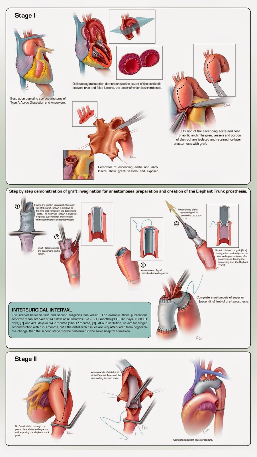 Corl Medical Media: The Elephant Trunk Procedure for Aortic Aneurysm ...