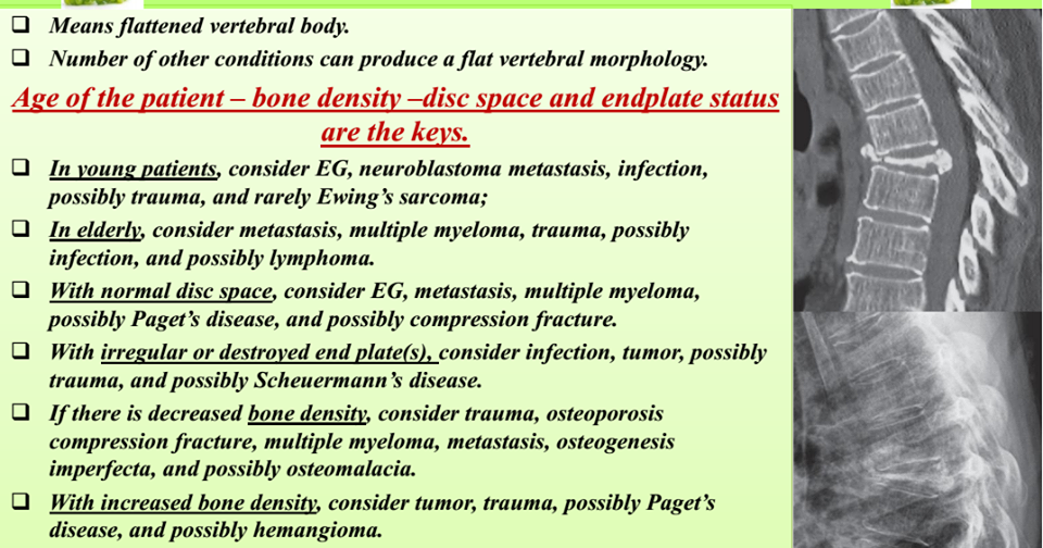 Easy Radiology: Vertebra plana