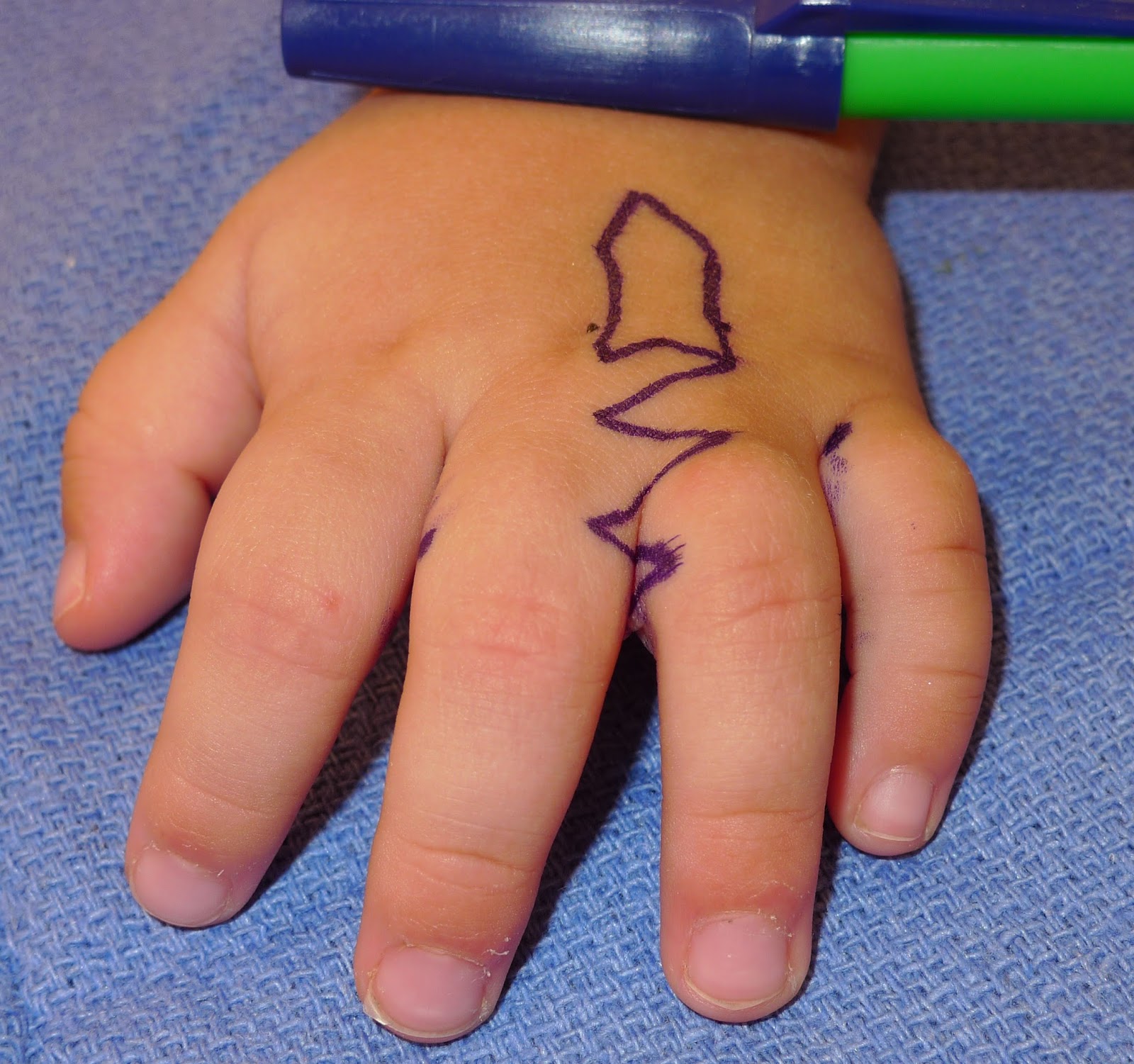 Partial Syndactyly | Congenital Hand and Arm Differences | Washington ...