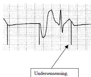 Simple Cardiology: - Temporary cardiac Pacemakers.