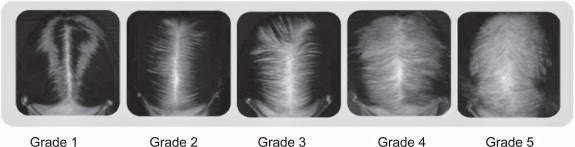 The Well-Rounded Mama: PCOS and Hair Loss, Part 1: Prevalence and Diagnosis