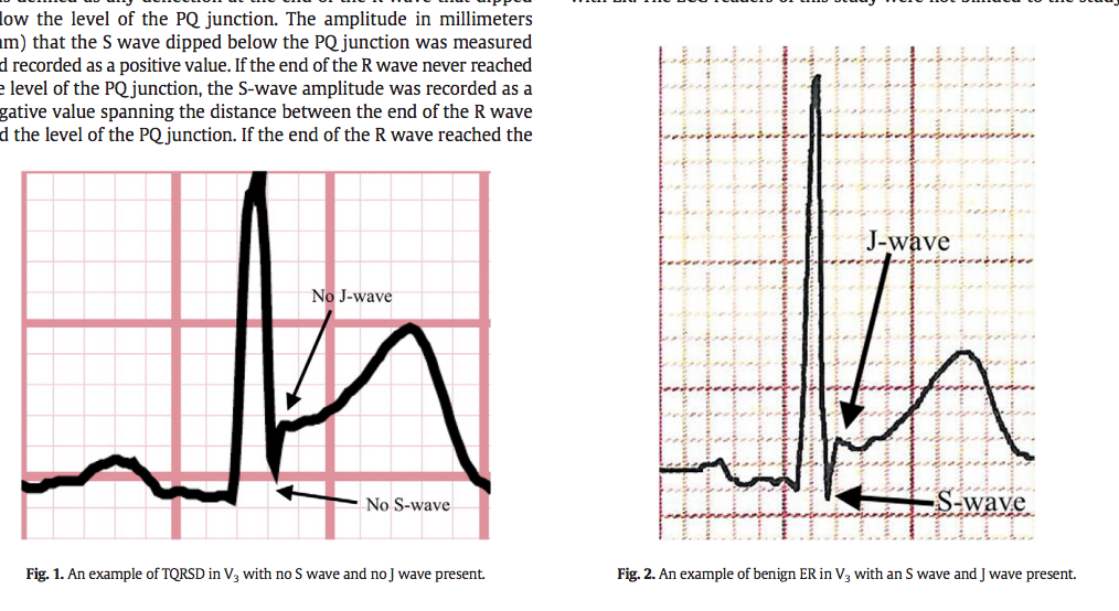 Dr. Smith's ECG Blog: An intoxicated, agitated, 20-something with chest ...