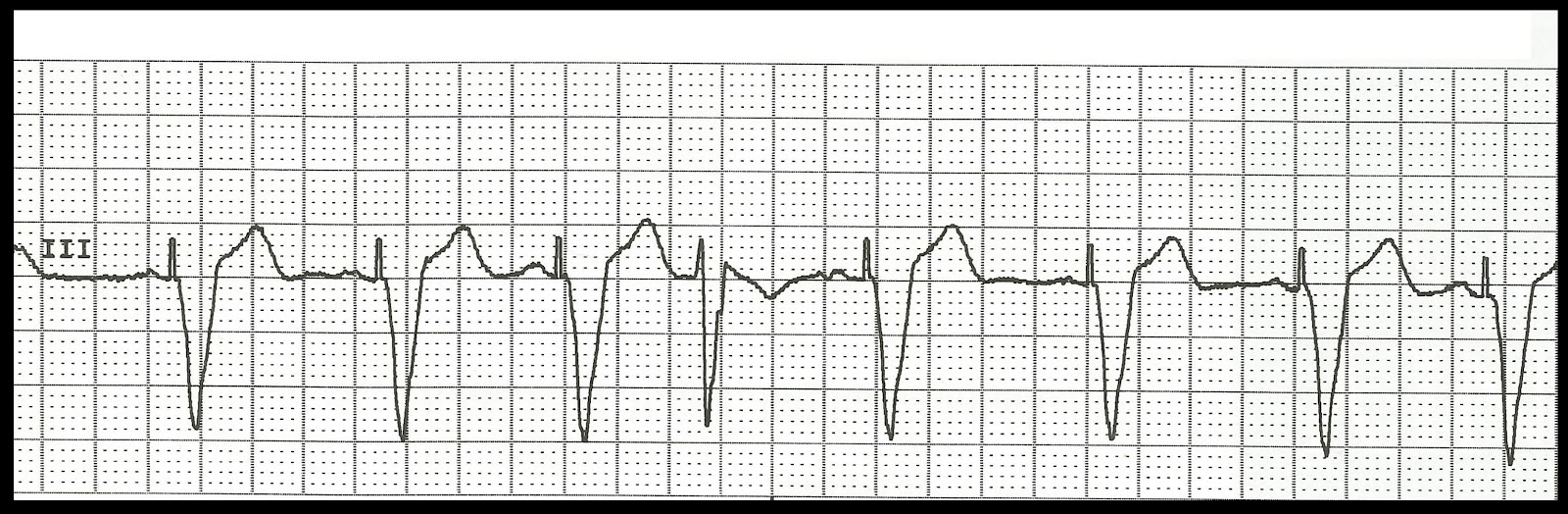 Practice EKG Rhythm Strips 163