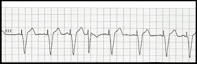 Practice EKG Rhythm Strips 163