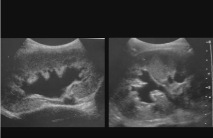 Flanco Esquerdo : Ultrassonografia Renal: visualização do rim e ...