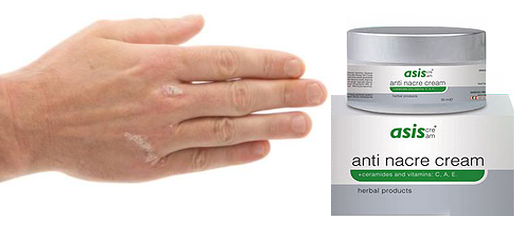 Asis Krem Kullanıcı Yorumları | Asis Sedef Kremi Kullananlar | Asis ...