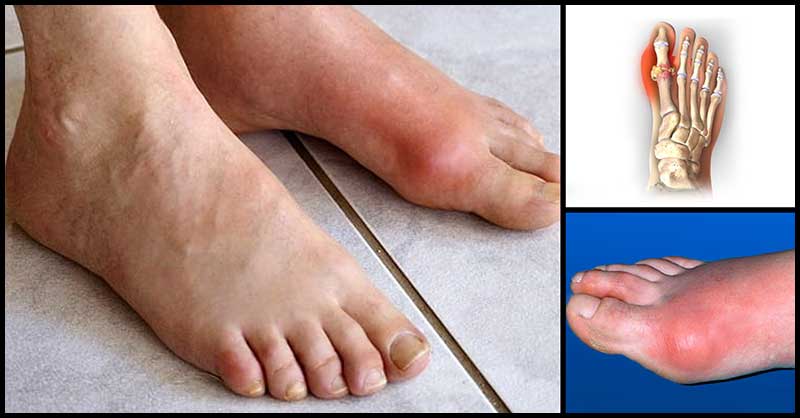 Helpful Tips To Prevent Gout Attacks | Dr Farrah MD