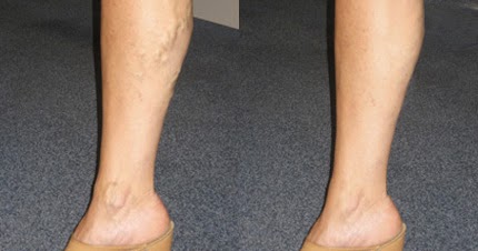 Como Se Quitan Las Varices: Opciones De Tratamiento | Como Quitar Las ...