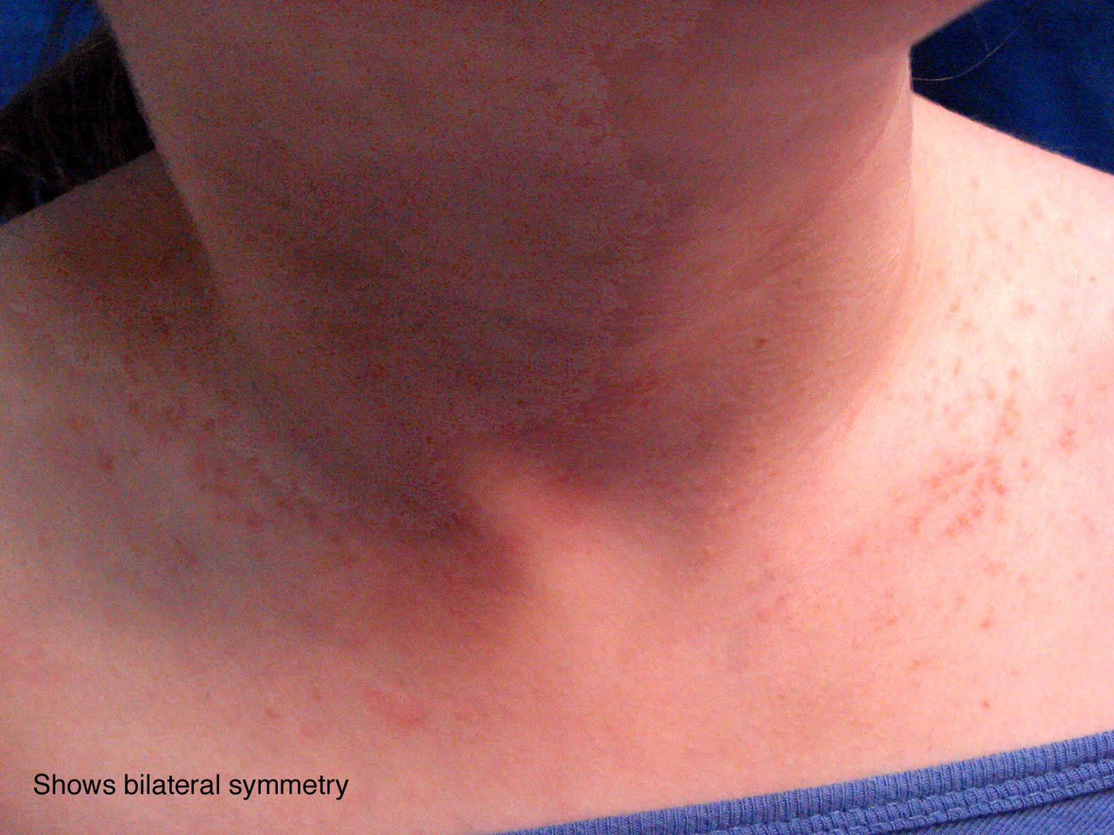 VIRTUAL GRAND ROUNDS IN DERMATOLOGY 2.0: Keratosis Follicularis