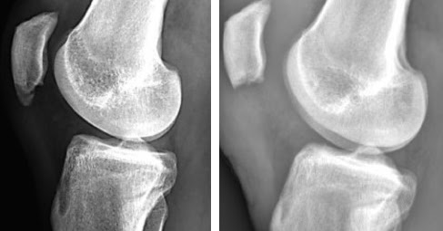 What Is Sinding-Larsen-Johansson Syndrome?