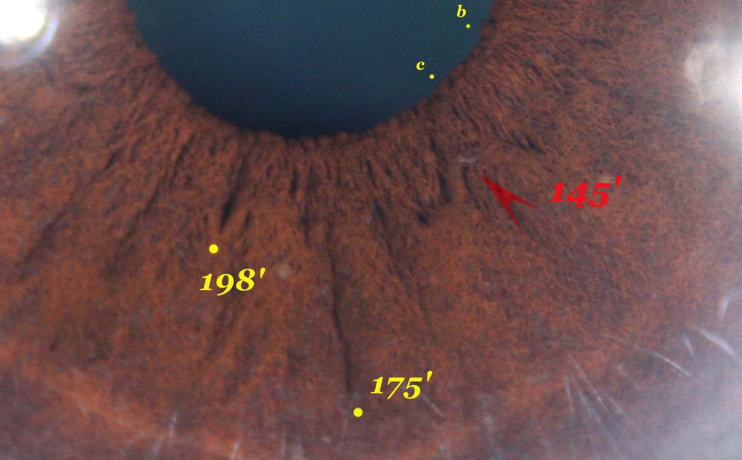 Modern & Multidimensional Iridology: Radial Furrows & Indentation of ...