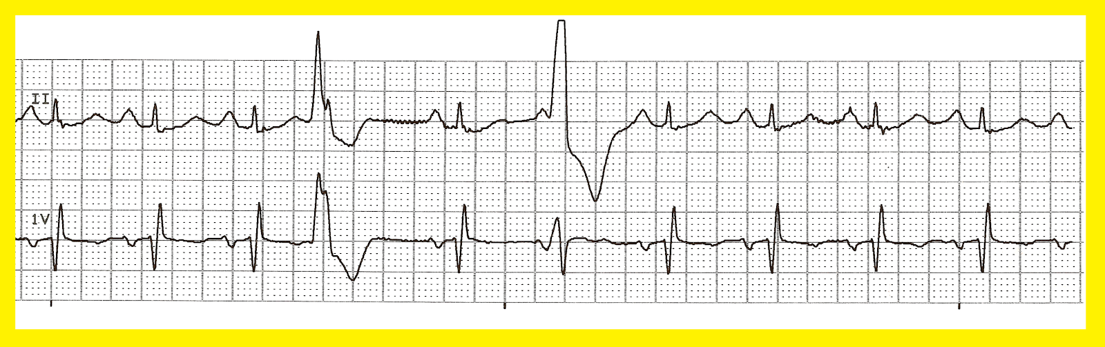 EKG Rhythm Quiz 287