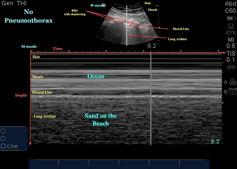 Emory Emergency Ultrasound: M-mode of the Lung