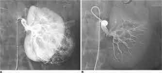 Medical Treatment Pictures-for Better Understanding: Embolization ...
