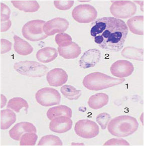 berbagi ilmu sesama manusia: Anemia Hemolitik