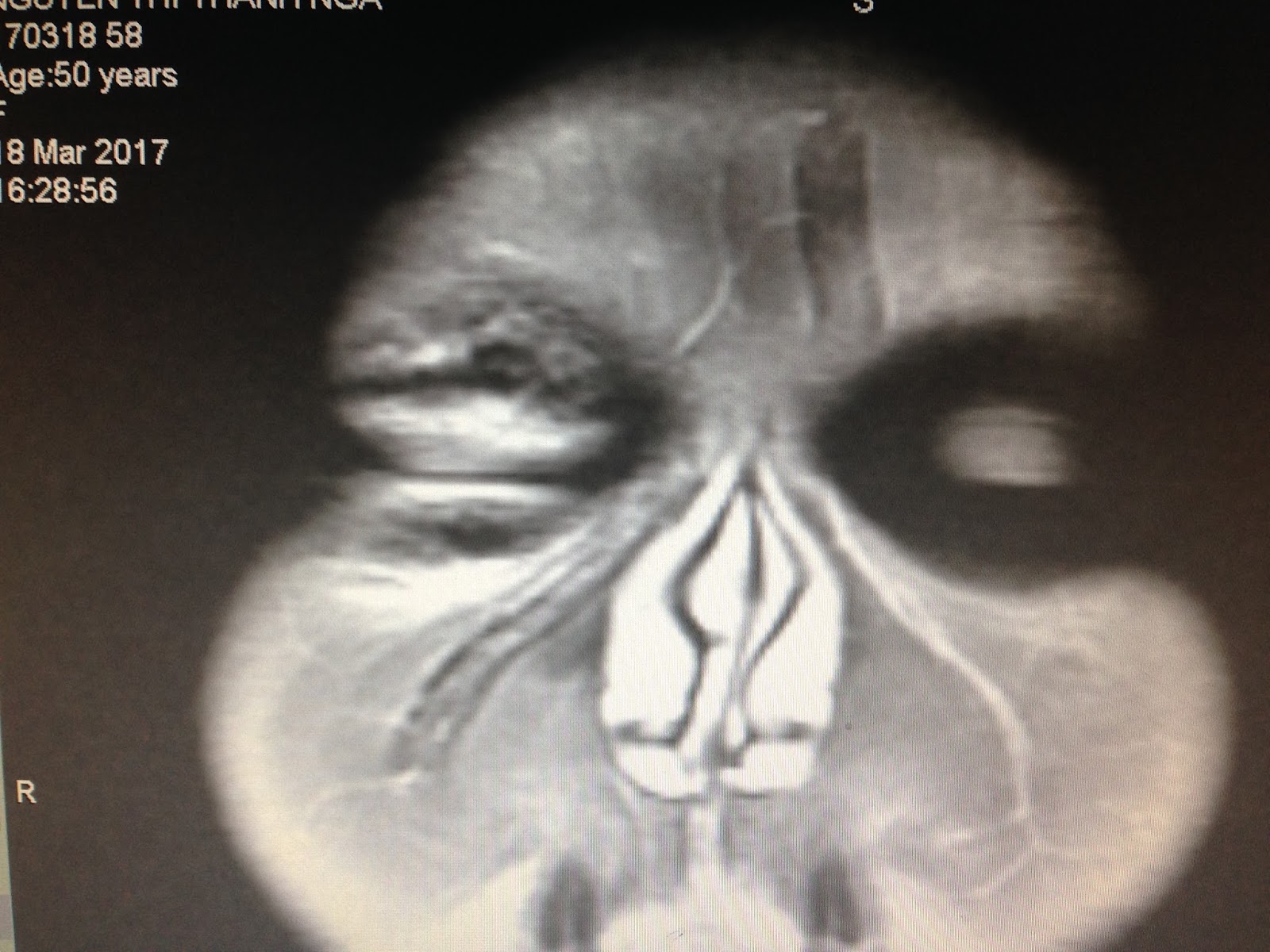 VIETNAMESE MEDIC ULTRASOUND: CASE 423: BLACK EYEBROW SIGN, Dr PHAN ...