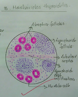 Histopathology Drawings: Hashimotos thyroiditis