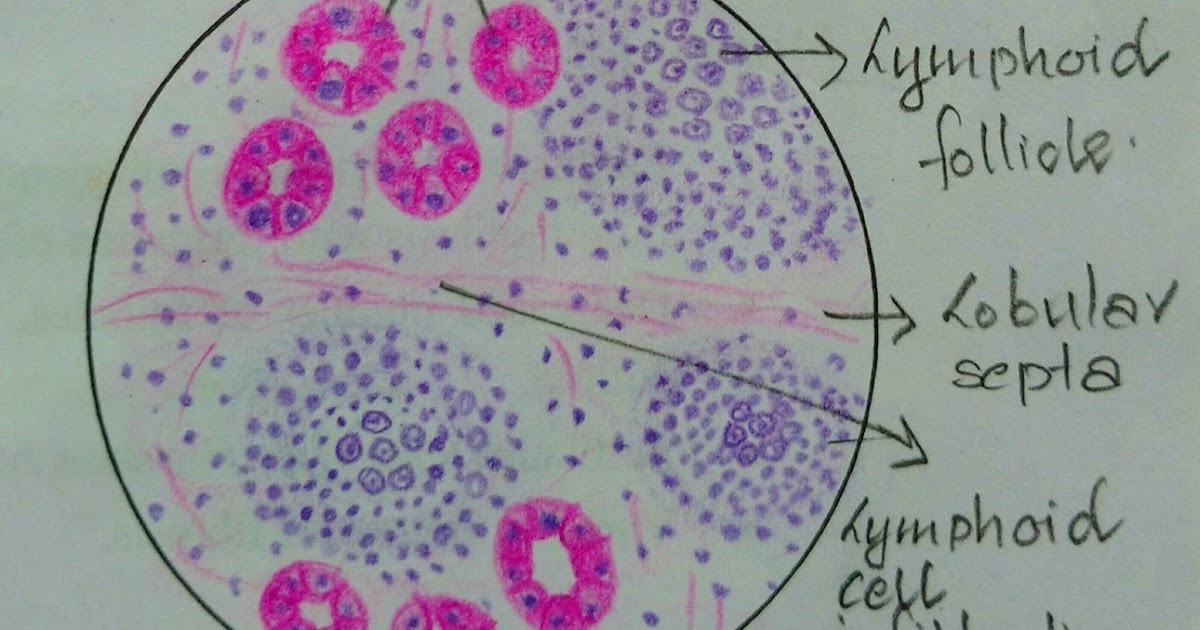 Histopathology Drawings: Hashimotos thyroiditis