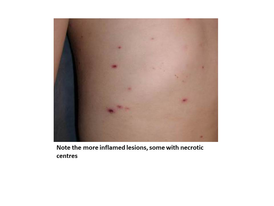 Consultations in Dermatology: Pityriasis Lichenoides PLEVA