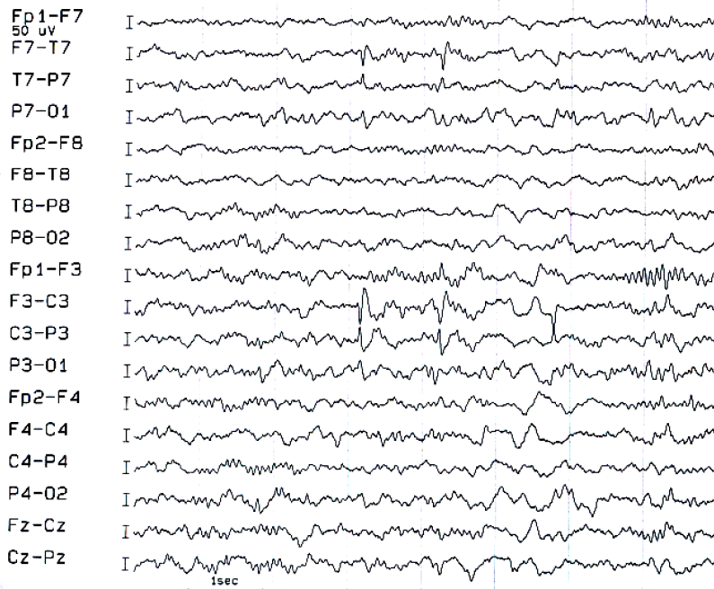 Approach to visual analysis of EEG