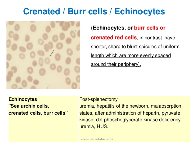 مدونة معملي للتحاليل الطبية والاختبارات المعمليه: Echinocytes : خلايا ...